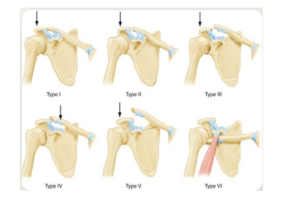 Luxação acromioclavicular - E-fisio