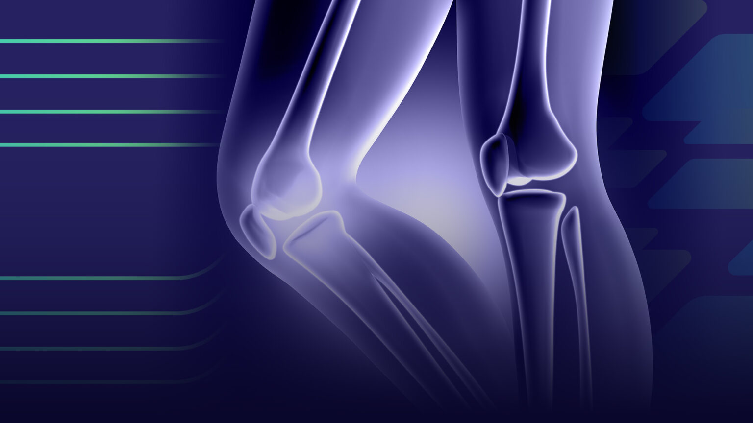 Fraturas de Platô Tibial - E-fisio