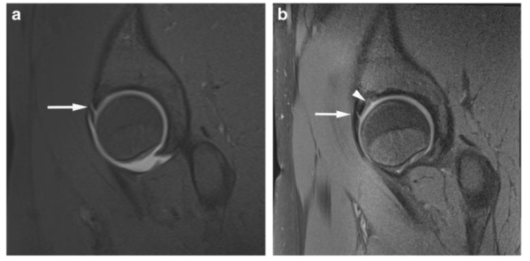 Síndrome do Impacto Femoroacetabular - E-fisio