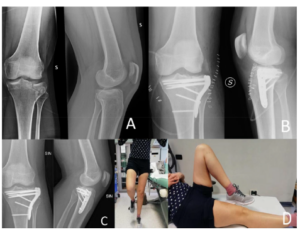 Fraturas de Platô Tibial - E-fisio