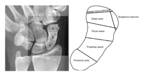 Fratura de escafóide - E-fisio